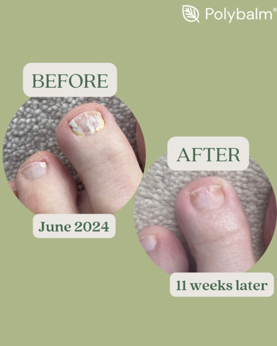 Polybalm Nail Remedy - Protect and Repair Nails During and After Chemo ...
